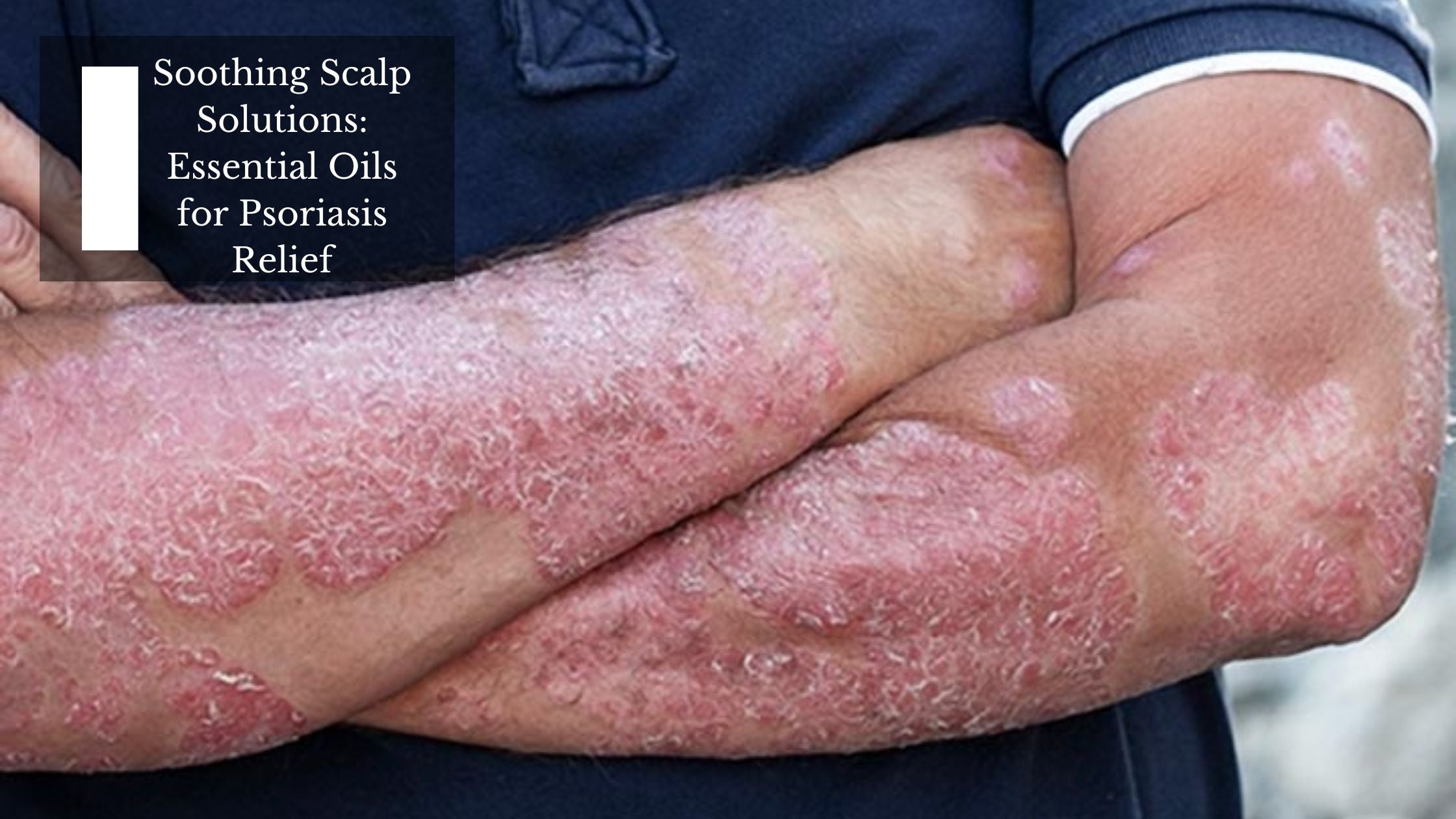 Soothing Scalp Solutions: Essential Oils for Psoriasis Relief – Moksha ...